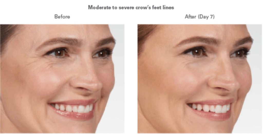 Seattle Botox Services | Blue Haven Medical Spa Ballard