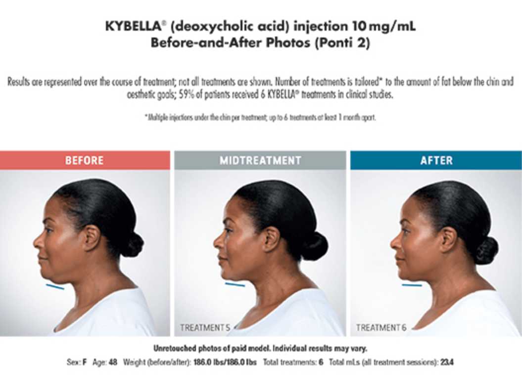 Seattle Kybella Services - Blue Haven Medical Spa Ballard