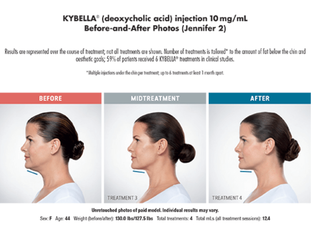 Seattle Kybella Services - Blue Haven Medical Spa Ballard