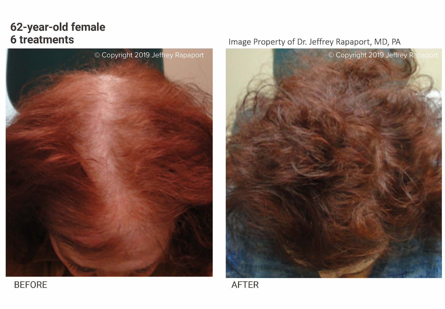 Seattle PRP Hair Restoration Services - Blue Haven Medical Spa Ballard
