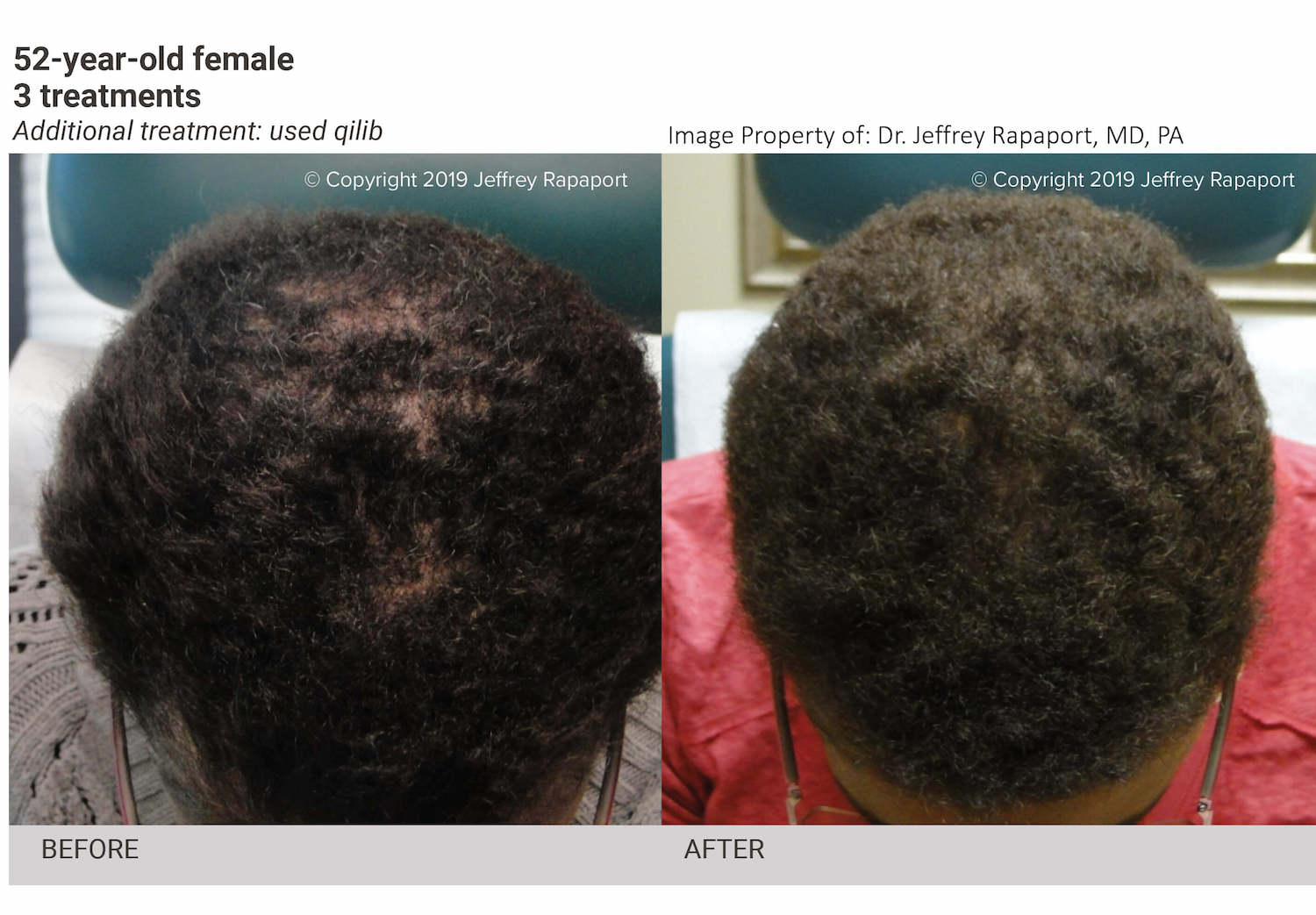 Seattle PRP Hair Restoration Services - Blue Haven Medical Spa Ballard